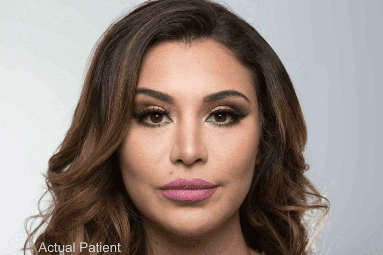 Everything You Need to Know About Buccal Fat Pad Removal - Frank Agullo, MD